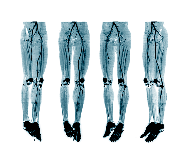 Embolia arterial :: Dr Sergio Moreno - Neurocirujano
