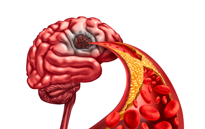 Riesgos de un derrame cerebral :: Dr Sergio Moreno - Neurocirujano Riesgos de un derrame cerebral :: Dr Sergio Moreno - Neurocirujano
